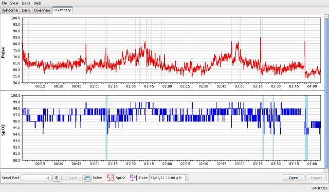 OSCAR: (the Open Source CPAP Analysis Reporter) is | AlternativeTo