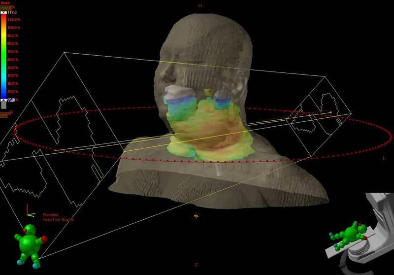 Varian Eclipse: Eclipse is a comprehensive treatment planning ...